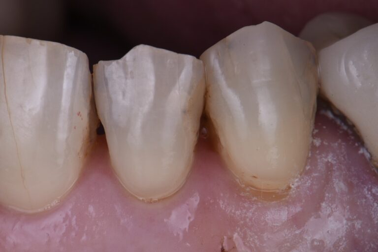 Deep subgingival Class V lesions with sensitivity