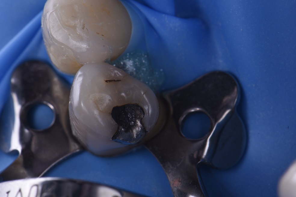 Kerr Simplishade Optical Refractive Index Compliance