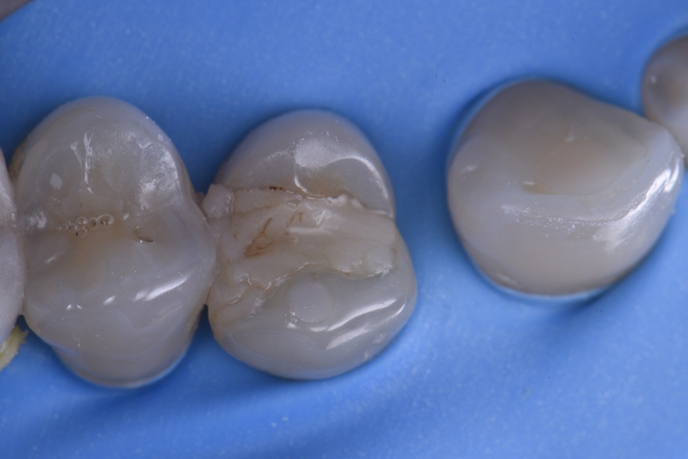 Restoring Marginal Failure on this First Premolar