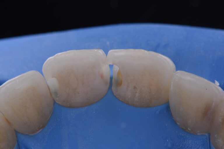 Hu-Friedy Akroflex embrasure development composite