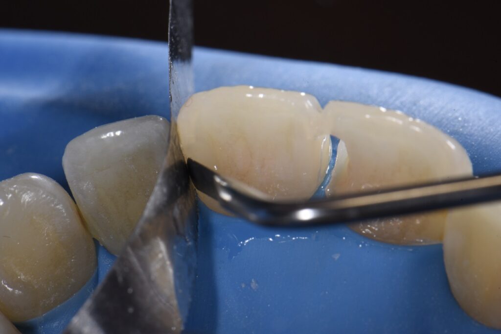 Hu-Friedy Akroflex embrasure development composite