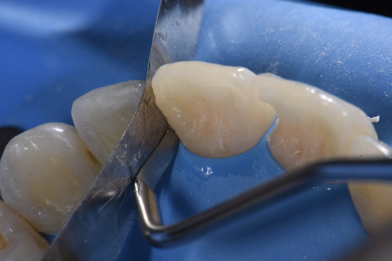 Hu-Friedy Akroflex embrasure development composite