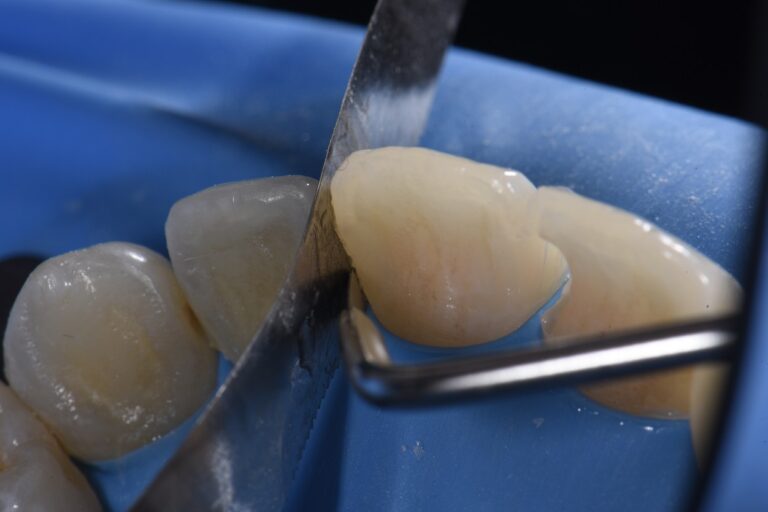 Hu-Friedy Akroflex embrasure development composite