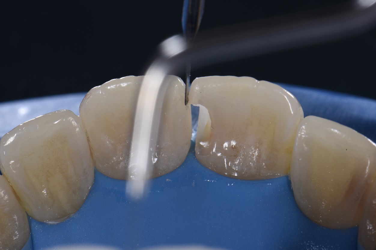 Hu-Friedy Akroflex embrasure development composite
