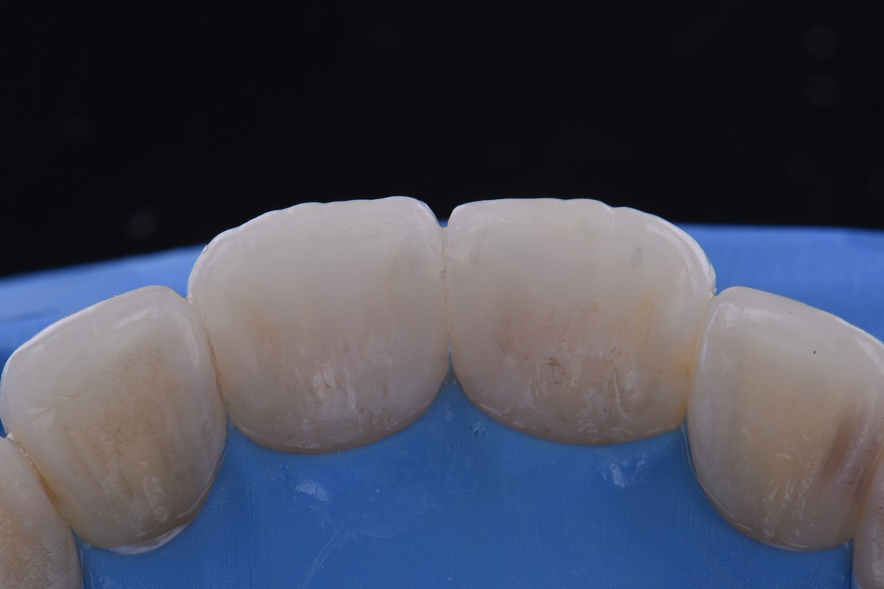 Hu-Friedy Akroflex embrasure development composite