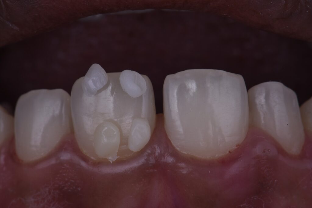 Ultradent Gemini | Ultradent Mosaic | Hu-Friedy Akroflex | Composite ...