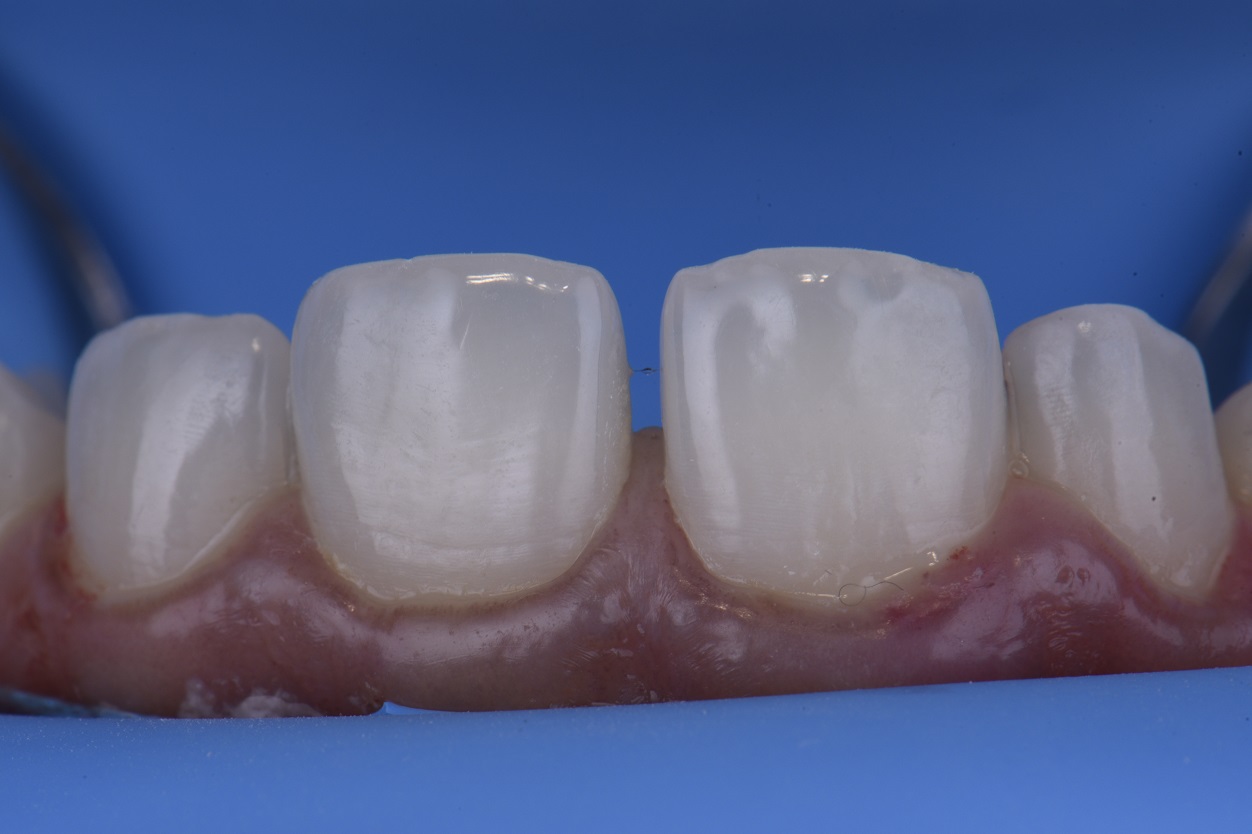 Ultradent Gemini | Ultradent Mosaic | Hu-Friedy Akroflex | Composite ...