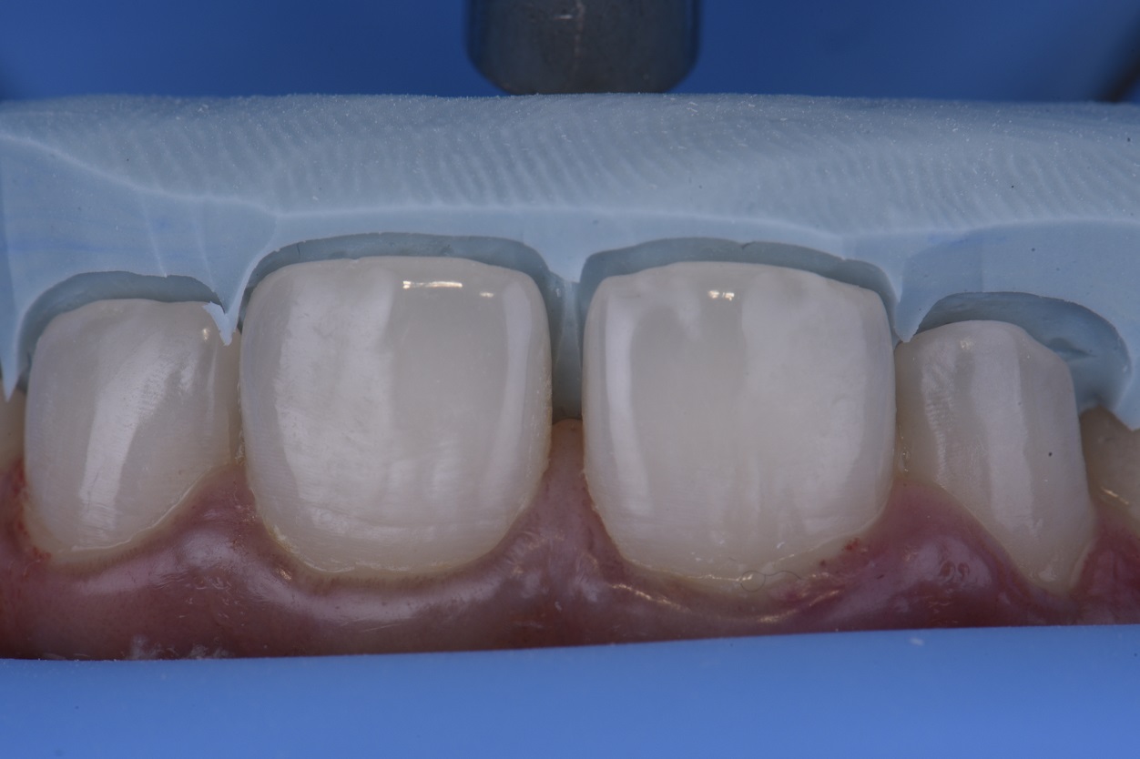 Ultradent Gemini | Ultradent Mosaic | Hu-Friedy Akroflex | Composite ...