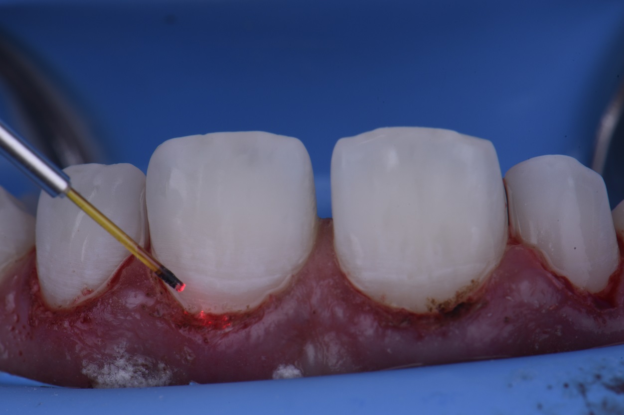 Ultradent Gemini | Ultradent Mosaic | Hu-Friedy Akroflex | Composite ...