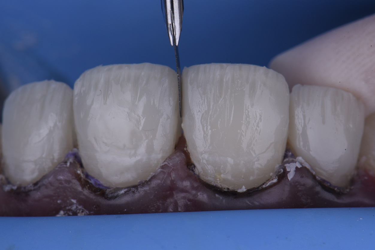 Ultradent Gemini | Ultradent Mosaic | Hu-Friedy Akroflex | Composite ...