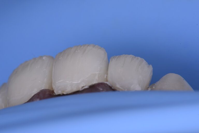 Ultradent Gemini | Ultradent Mosaic | Hu-Friedy Akroflex | Composite ...