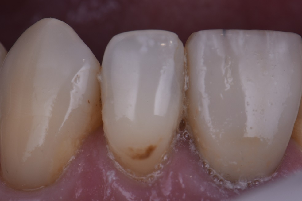 Incipient caries removal and invisible restoration