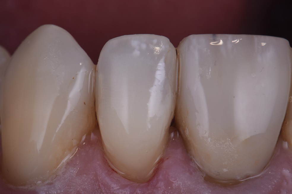 Incipient caries removal and invisible restoration