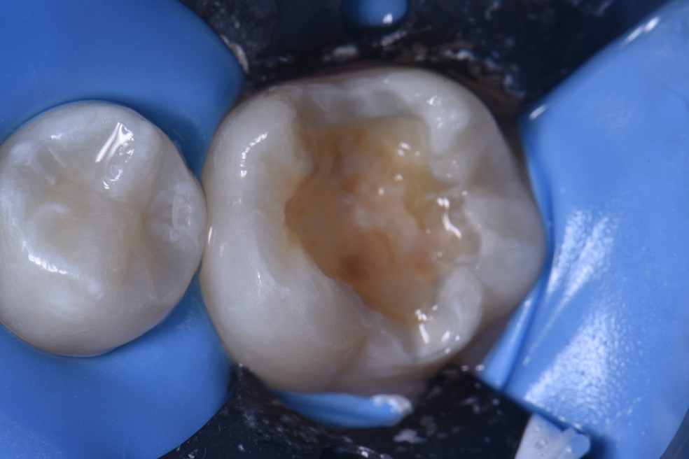 Molar Hypomineralization Composite Restoration