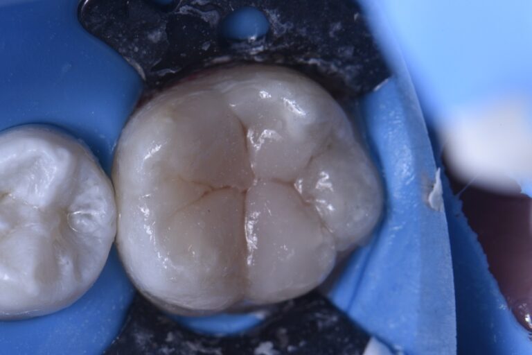 Molar Hypomineralization Composite Restoration