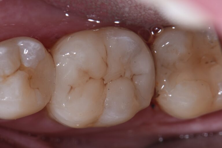 Class II composite restorations with a Supercomposite