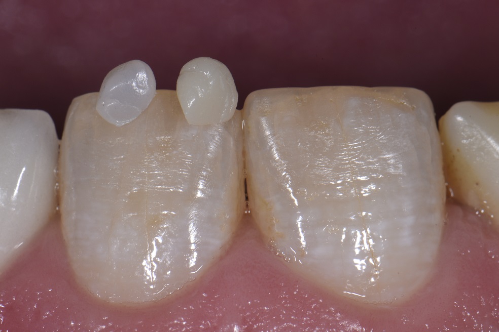 Edge Bonding to restore a chipped tooth
