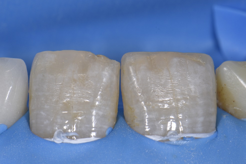 Edge Bonding to restore a chipped tooth