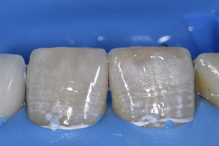 Edge Bonding to restore a chipped tooth