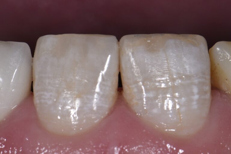 Edge Bonding to restore a chipped tooth