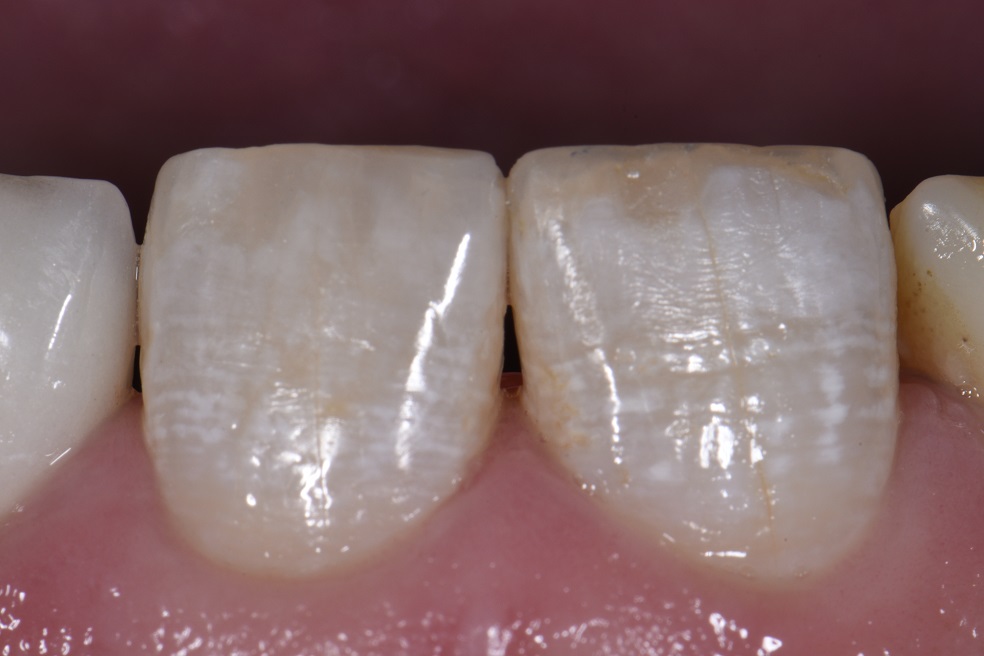 Edge Bonding to restore a chipped tooth