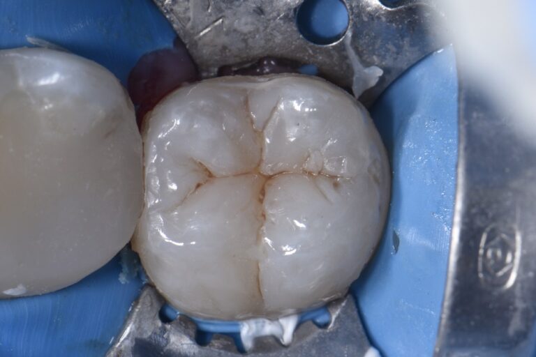 Tooth #31MOB Chameleon Cloud Shaded Resin Restoration