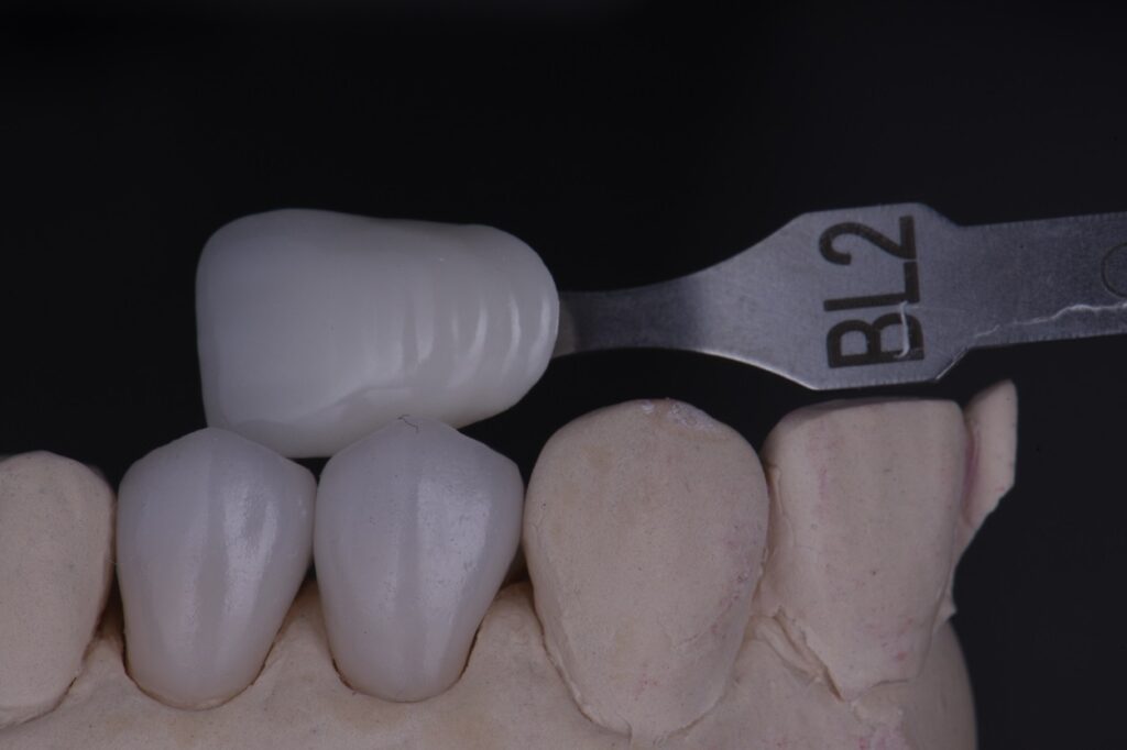 Translucent conservative porcelain onlay and overlays