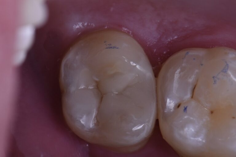 Class II restoration replacement