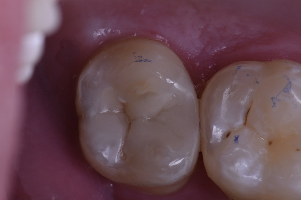 Class II restoration replacement