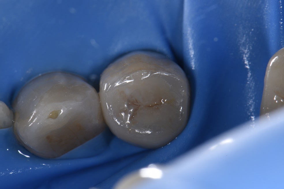 A.P.C. Technique for Zirconia Implant Crown access closures