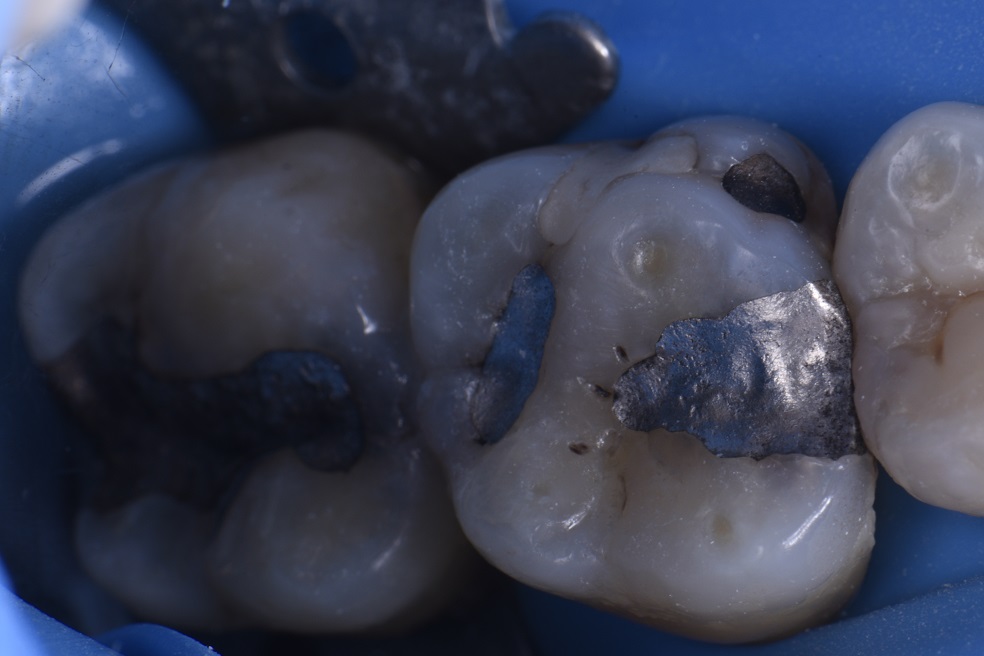 Kerr Simplishade Complex Composite Restorations