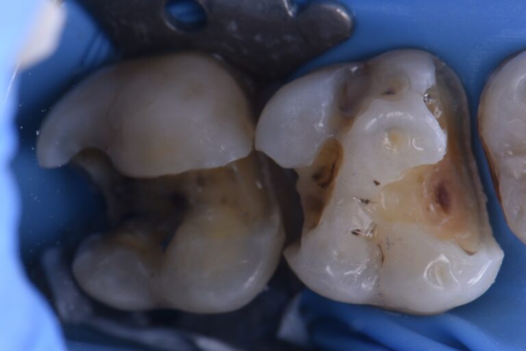Kerr Simplishade Complex Composite Restorations
