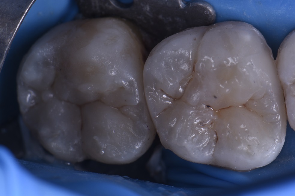Kerr Simplishade Complex Composite Restorations