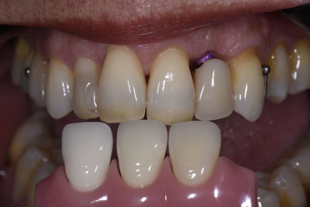 Creating Invisibly Perfect Implant Crowns in the Esthetic Zone