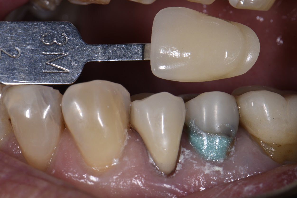 Adhesive Bonding Protocol for e-max overlay Adhesive Bonding Protocol ...