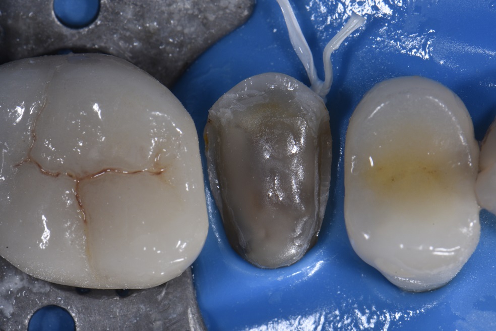 Adhesive Bonding Protocol for e-max overlay Adhesive Bonding Protocol ...