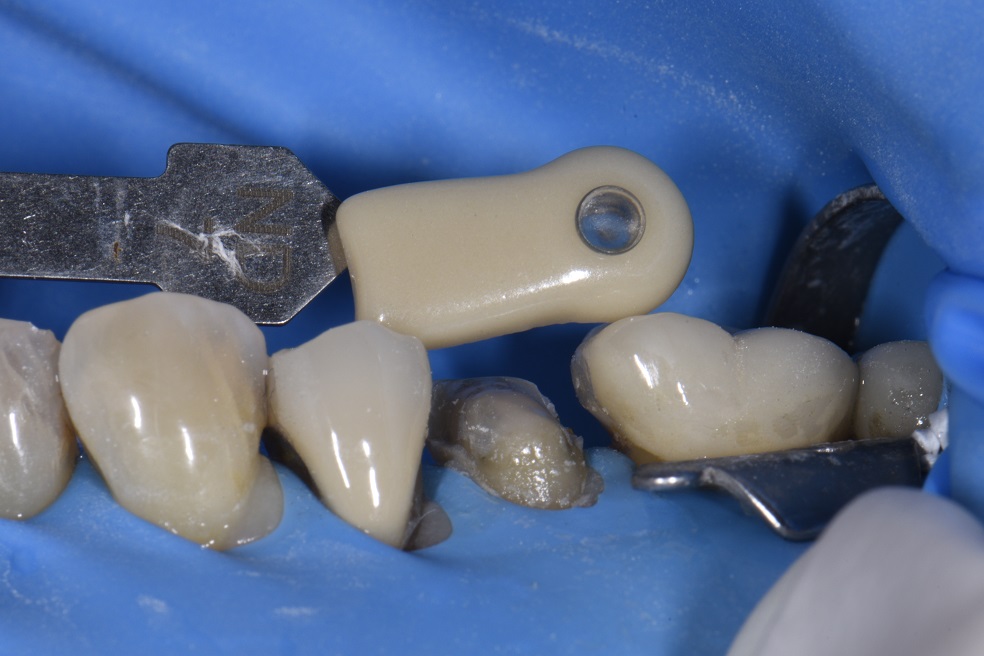 Adhesive Bonding Protocol for e-max overlay Adhesive Bonding Protocol ...