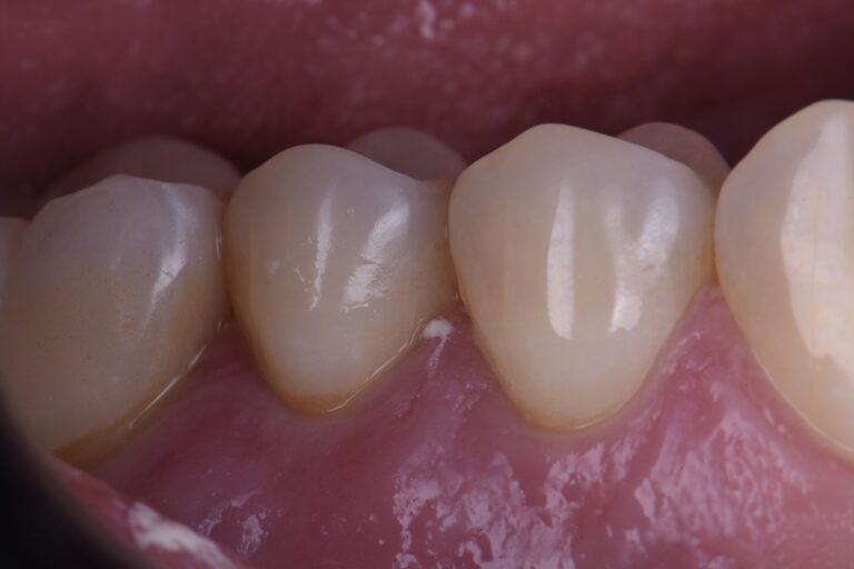 Root Scrubbing Holes Non Carious Cervical Abrasion Lesions