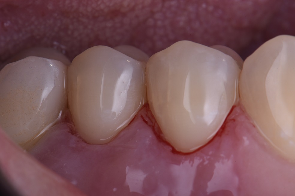 Root Scrubbing Holes Non Carious Cervical Abrasion Lesions
