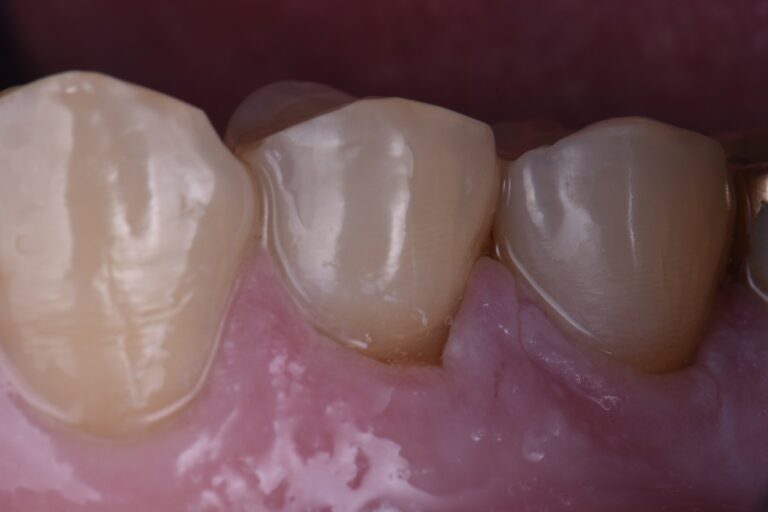 Root abrasion lesions from toothbrushing