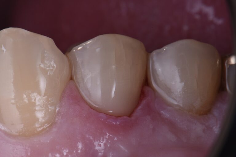 Root abrasion lesions from toothbrushing