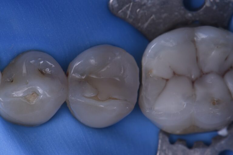 Kerr Simplishade Invisible Composite Restorations