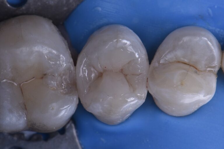 MOD cavity restored with a single shade of Voco Grandio SO