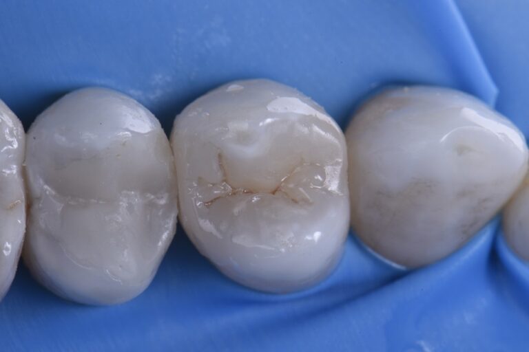 Replacing Old Fillings with Invisible Composite