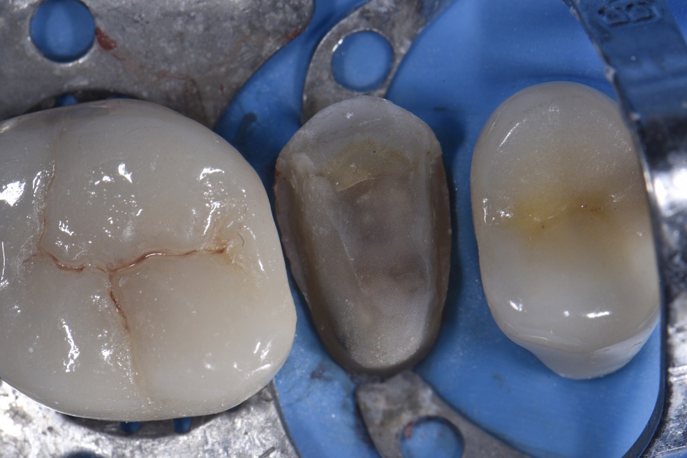 Adhesive Bonding Protocol for e-max overlay Adhesive Bonding Protocol ...