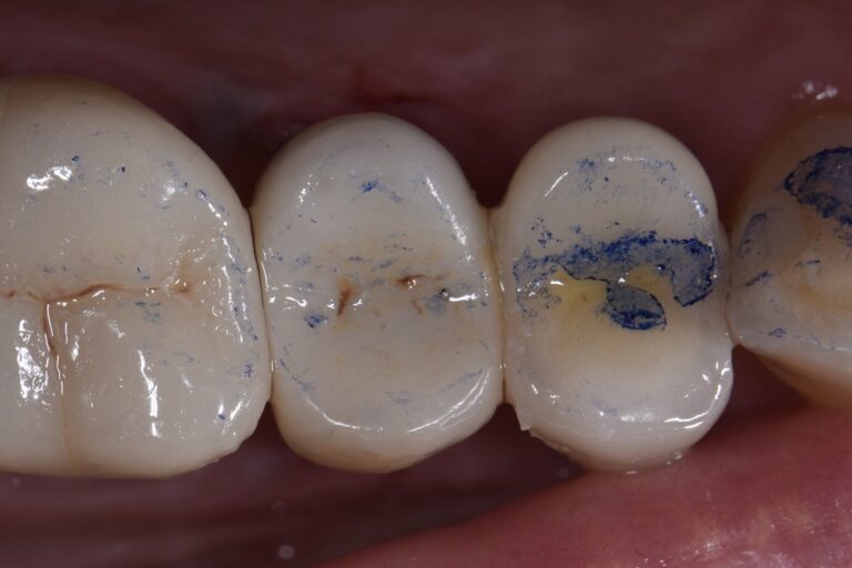 Adhesive Bonding Protocol for e-max overlay Adhesive Bonding Protocol ...