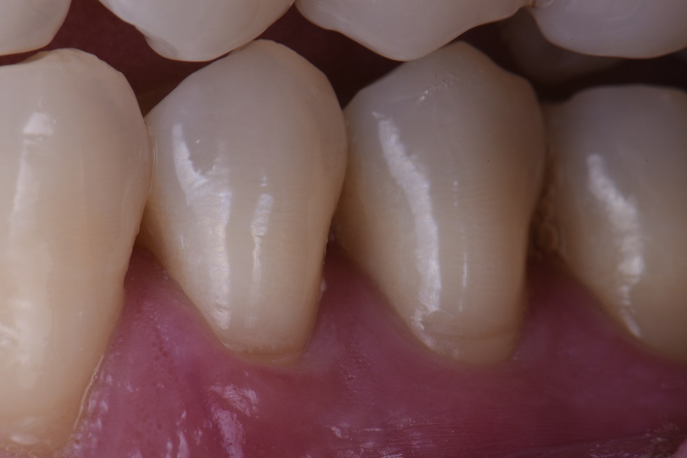 Root Abrasion from Toothbrushing Reversed Root Abrasion from ...