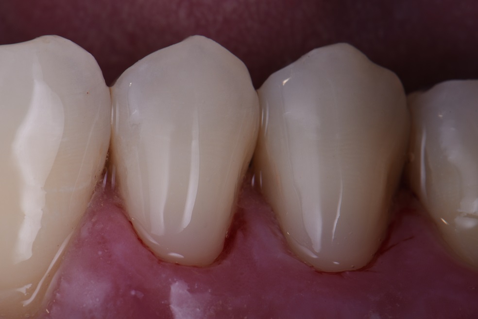 Root Abrasion from Toothbrushing Reversed Root Abrasion from ...