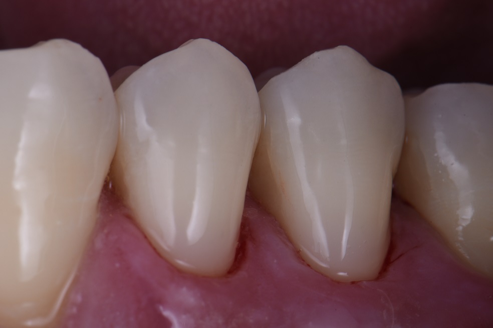 Root Abrasion from Toothbrushing Reversed Root Abrasion from ...