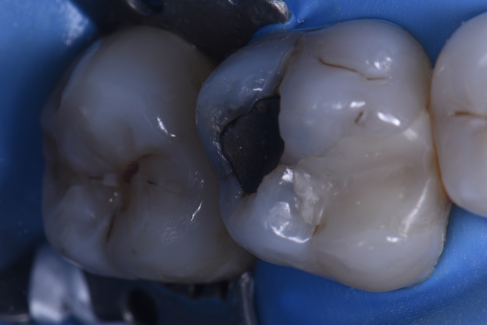 Amalgam removal result Amalgam is not a biocompatible material